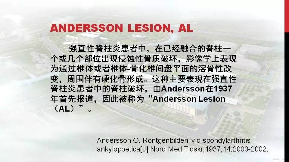 强直性脊柱炎Andersson Lesion的诊断和治疗策略 - 好医术早读文章 - 好医术-赋能医生守护生命