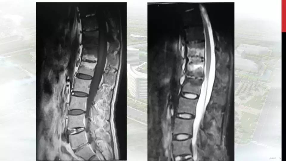 强直性脊柱炎Andersson Lesion的诊断和治疗策略 - 好医术早读文章 - 好医术-赋能医生守护生命