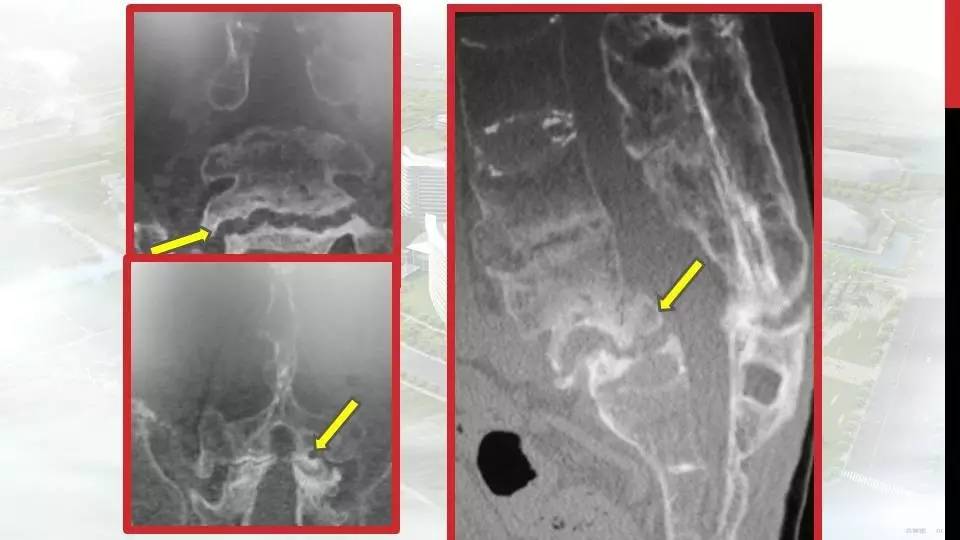 强直性脊柱炎Andersson Lesion的诊断和治疗策略 - 好医术早读文章 - 好医术-赋能医生守护生命