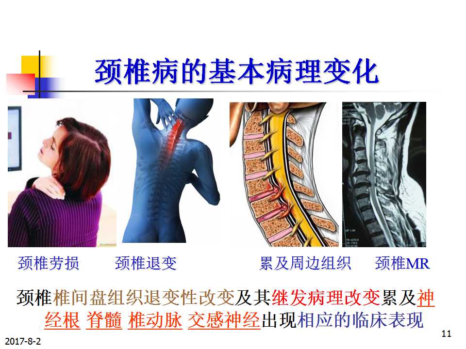颈椎病的分型与治疗要点解析 好医术早读文章 好医术 赋能医生守护生命