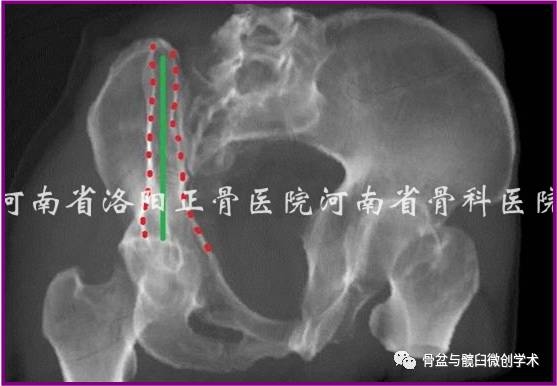 LC-II螺钉的经皮置入技术及其在骨盆髋臼骨折治疗中的应用