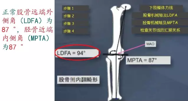 胫骨高位截骨术(HTO)治疗膝关节骨关节炎