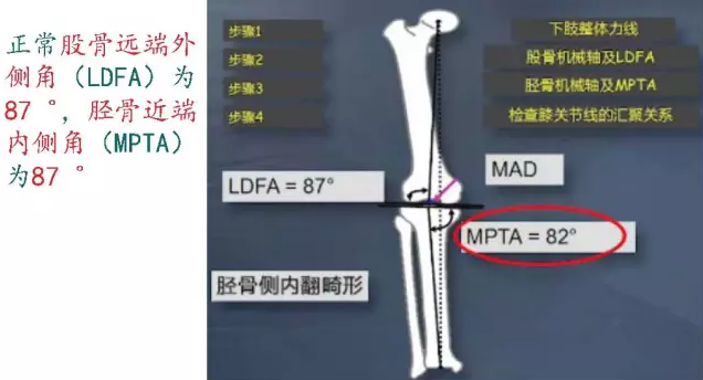胫骨高位截骨术(HTO)治疗膝关节骨关节炎