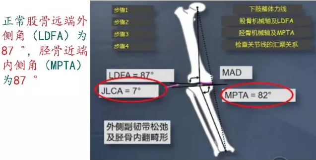胫骨高位截骨术(HTO)治疗膝关节骨关节炎 - 好医术早读文章 - 好医术-赋能医生守护生命