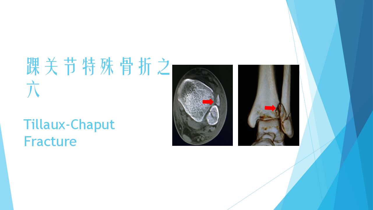 特殊类型的踝关节骨折（六）：Tillaux-Chaput Fracture - 好医术早读文章 - 好医术-赋能医生守护生命
