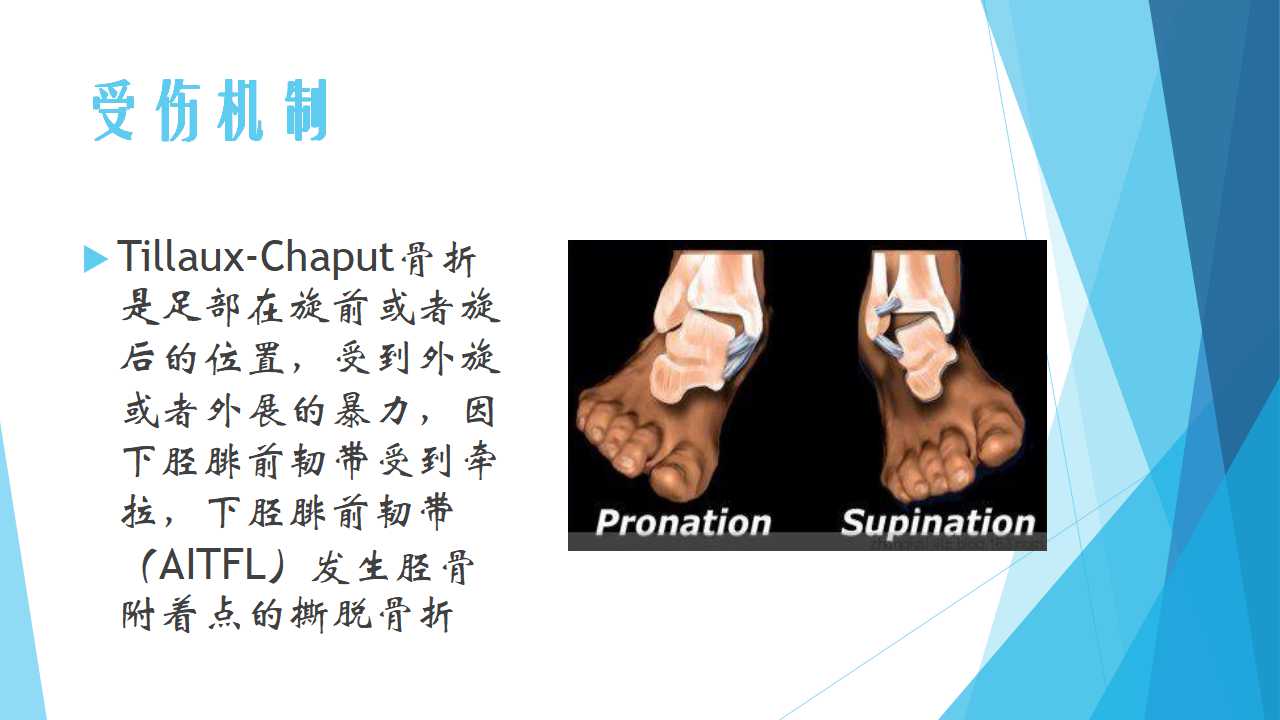 特殊类型的踝关节骨折（六）：Tillaux-Chaput Fracture - 好医术早读文章 - 好医术-赋能医生守护生命