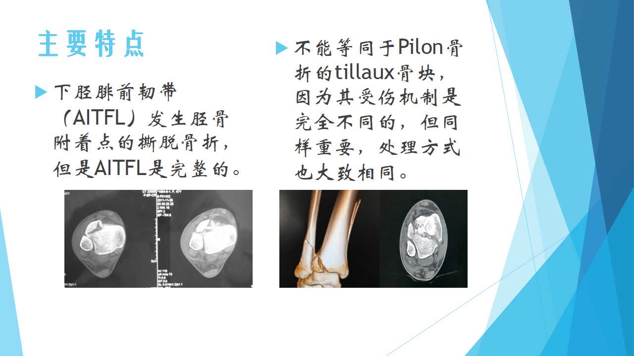 特殊类型的踝关节骨折（六）：Tillaux-Chaput Fracture - 好医术早读文章 - 好医术-赋能医生守护生命