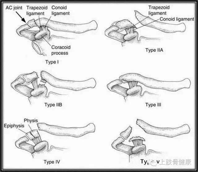 锁骨远端骨折的临床诊治要点 - 好医术早读文章 - 好医术-赋能医生守护生命