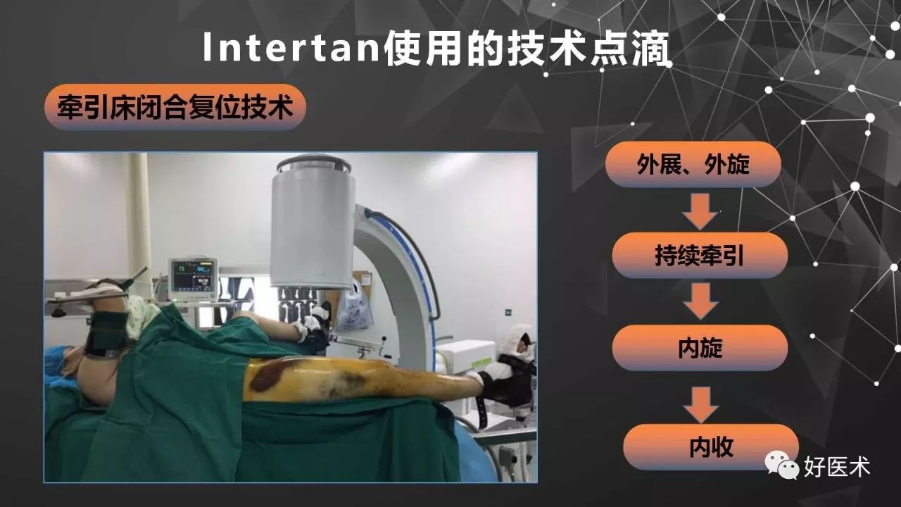 Intertan在股骨粗隆间骨折的应用及技术要点 - 好医术早读文章 - 好医术-赋能医生守护生命