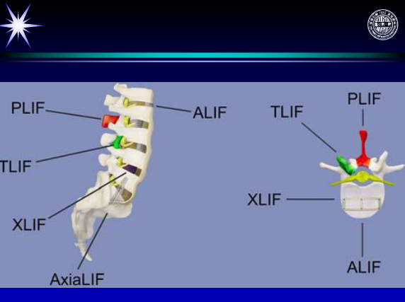 腰椎PLIF手术的并发症及其防治 - 好医术早读文章 - 好医术-赋能医生守护生命