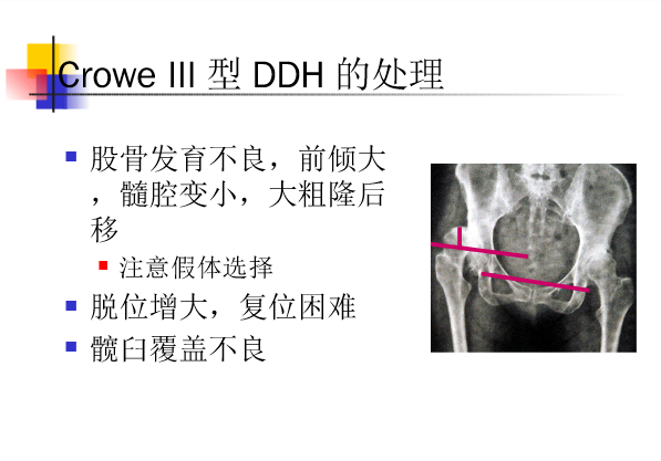 成人DDH的人工髋关节置换术