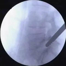 一篇掌握：经皮椎间孔镜椎间盘切除术(PTED)