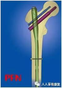 转子间骨折髓内固定（PFNA）的术后康复 - 好医术早读文章 - 好医术-赋能医生守护生命