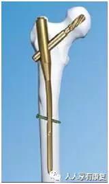 转子间骨折髓内固定（PFNA）的术后康复 - 好医术早读文章 - 好医术-赋能医生守护生命