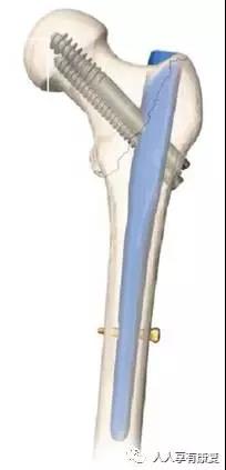 转子间骨折髓内固定（PFNA）的术后康复 - 好医术早读文章 - 好医术-赋能医生守护生命