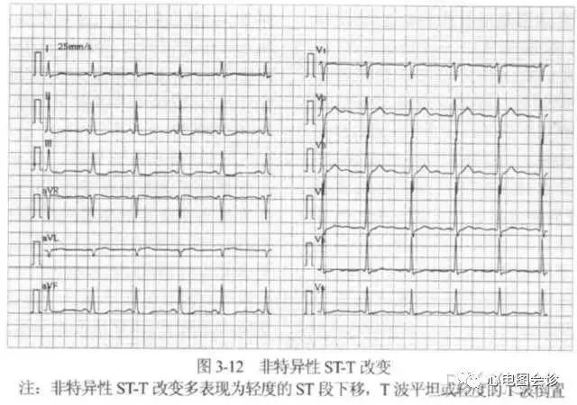 ST-T 改变的临床意义 - 好医术早读文章 - 好医术-赋能医生守护生命