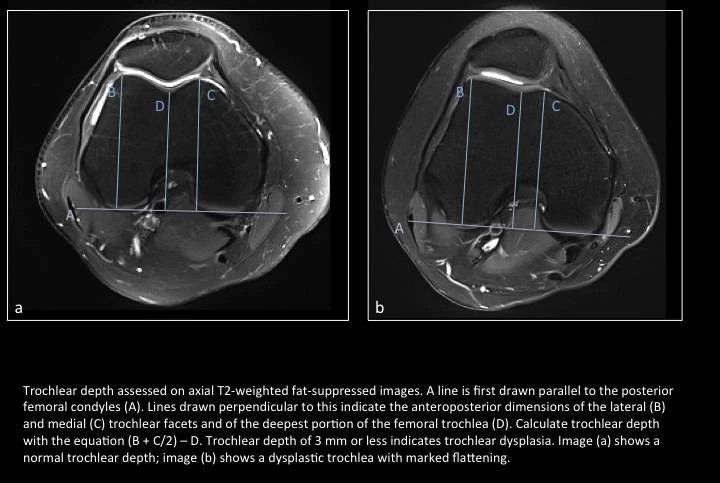 22副图，让您了解髌骨正常解剖、变异及常见疾病
