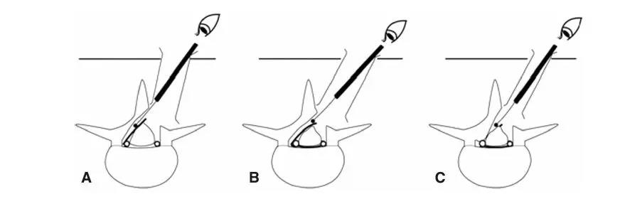 推荐：腰椎管狭窄症的单侧入路双侧减压技术 - 好医术早读文章 - 好医术-赋能医生守护生命
