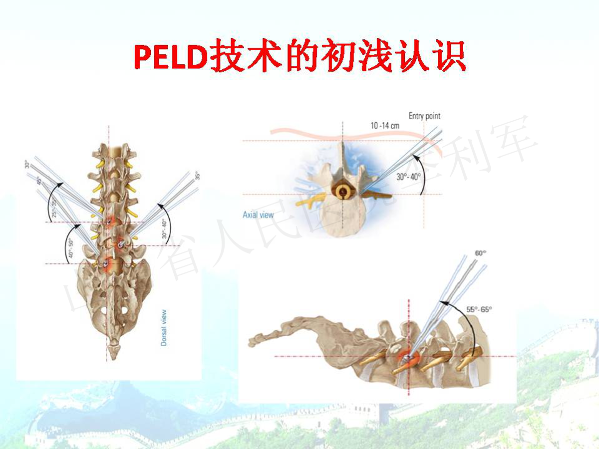 PELD技术要点详解，都在这篇课件里！ - 好医术早读文章 - 好医术-赋能医生守护生命