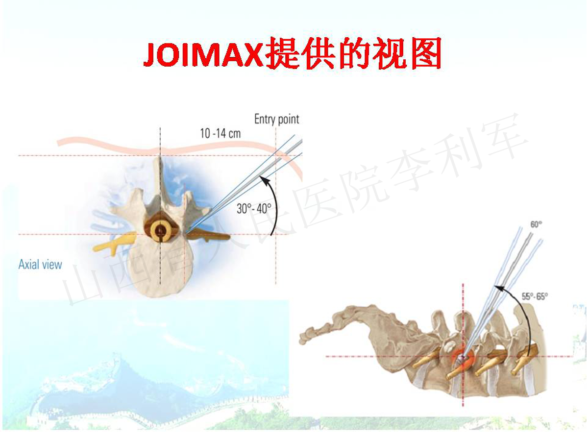 PELD技术要点详解，都在这篇课件里！ - 好医术早读文章 - 好医术-赋能医生守护生命