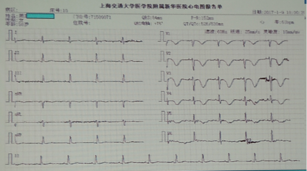 许之民：不要错过急性肺栓塞的心电图表现